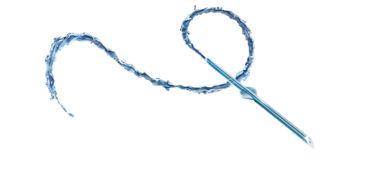 Minimalinvasive filtrierende Glaukomoperationen (MIBS) | Glaukom ... Minimalinvasive filtrierende Glaukomoperationen (MIBS) | Glaukom ...