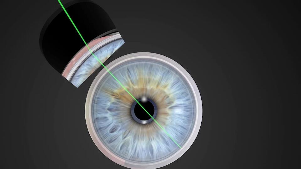 Grüner Star (Glaukom) und die schonende Therapie mit dem SLT-Laser ...